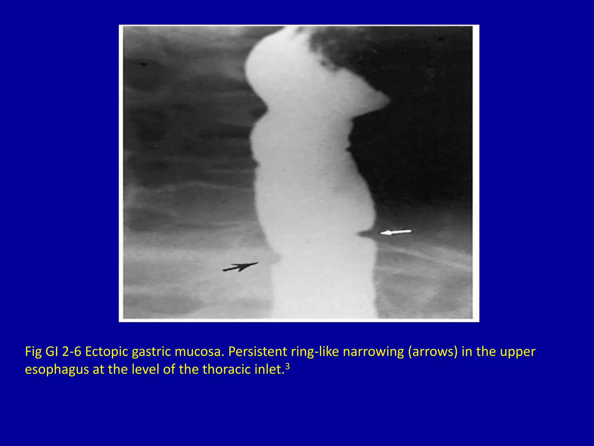 2 extrinsic impressions on the cervical esophagus | PPT