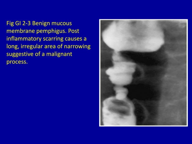 2 extrinsic impressions on the cervical esophagus | PPT