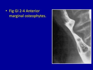 2 extrinsic impressions on the cervical esophagus | PPT