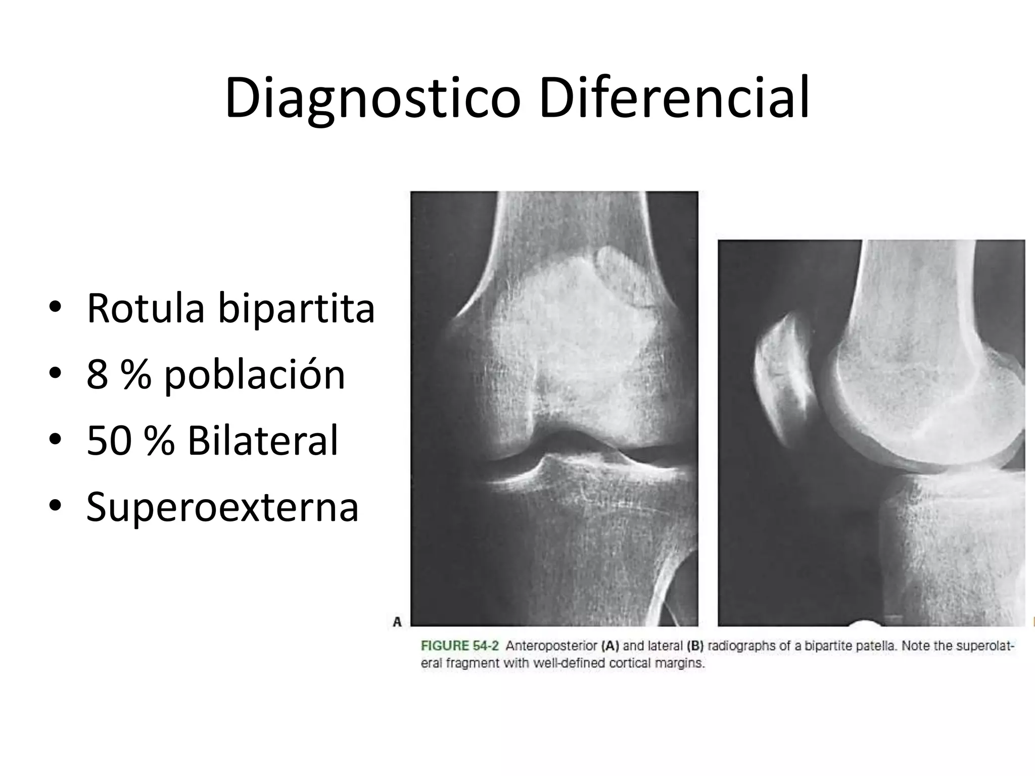 Fractura de rotula | PPTX