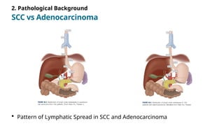 Two field vs Three field Lymphadenectomy in Esophageal Cancer | PPTX