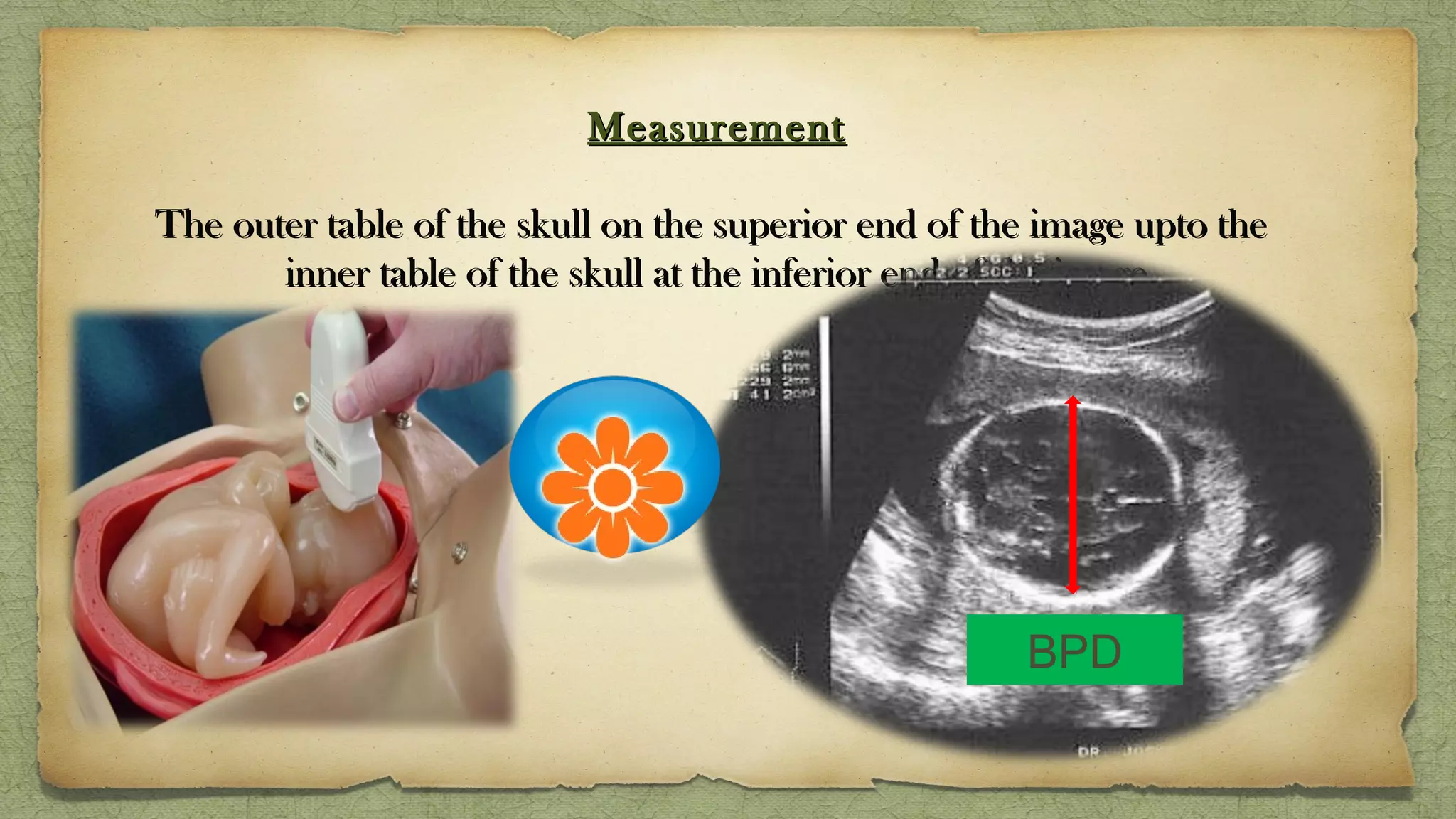 2nd trimester ultrasound.. | PPT