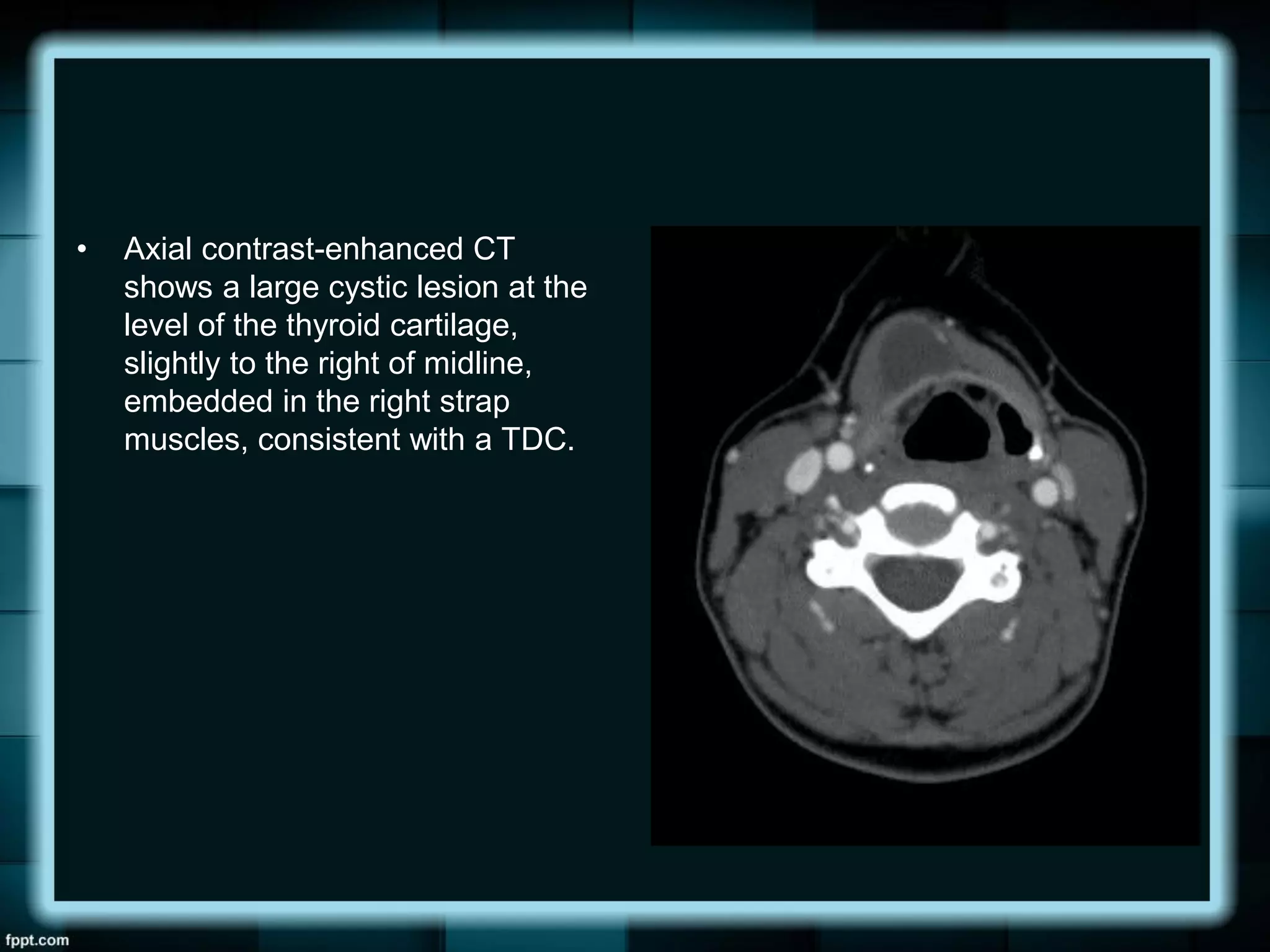 Case of the week : Thyroglossal cyst | PDF