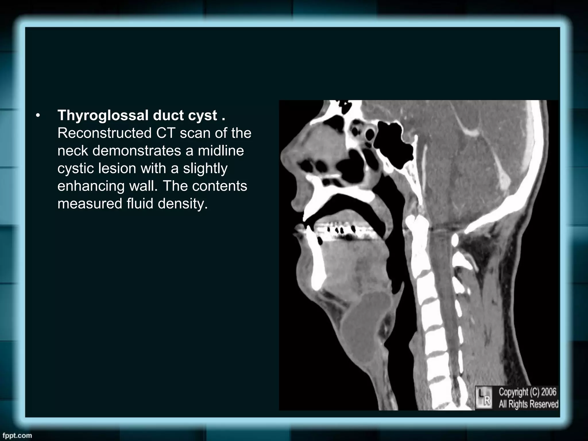 Case of the week : Thyroglossal cyst | PDF
