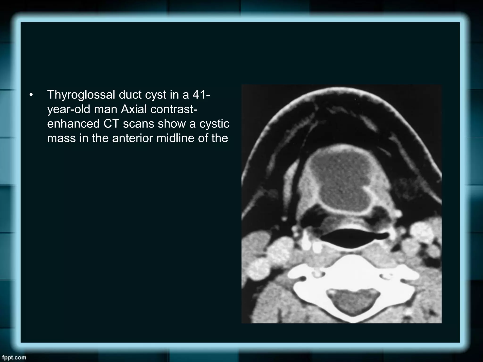 Case of the week : Thyroglossal cyst | PDF
