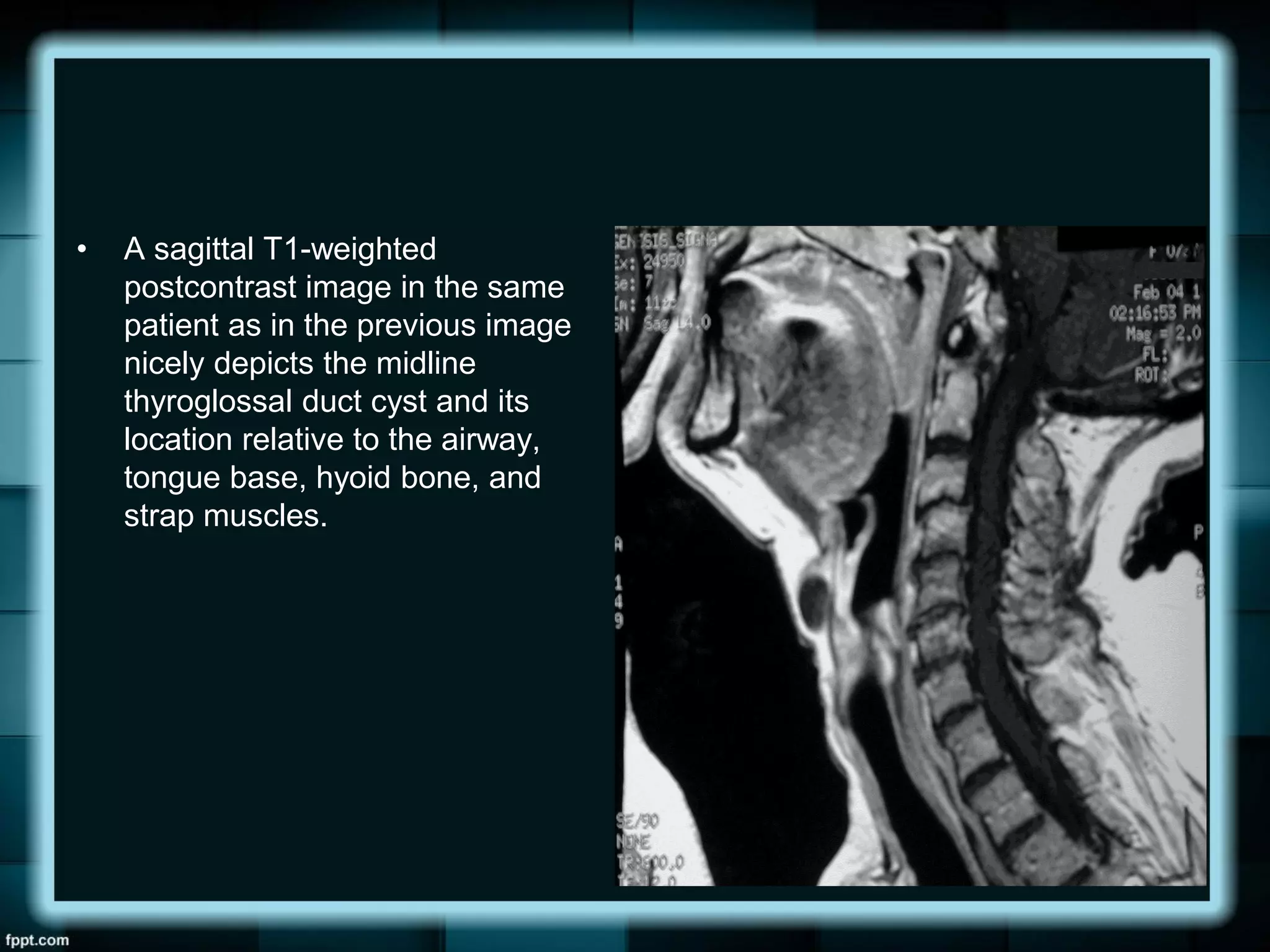 Case of the week : Thyroglossal cyst | PDF
