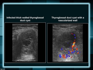 Thyroglossal Duct Cyst Ultrasound