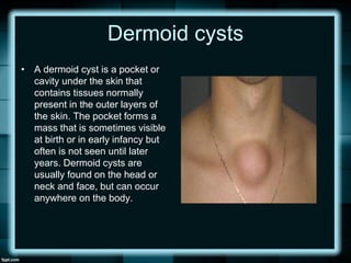 Dermoid Cyst Neck