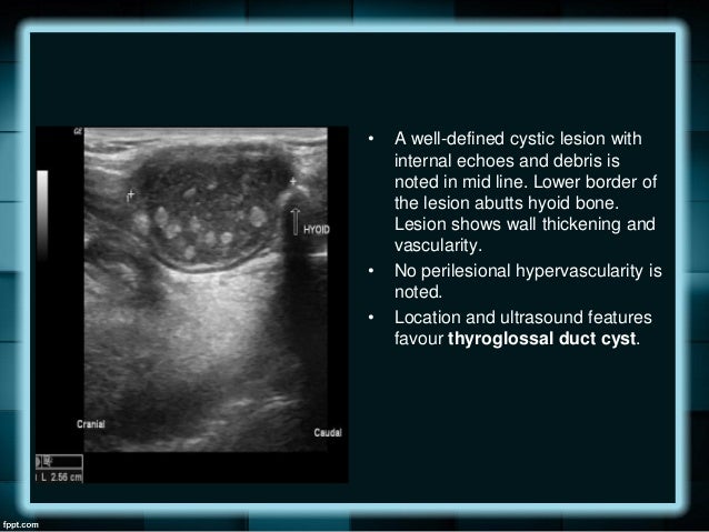 Case of the week : Thyroglossal cyst