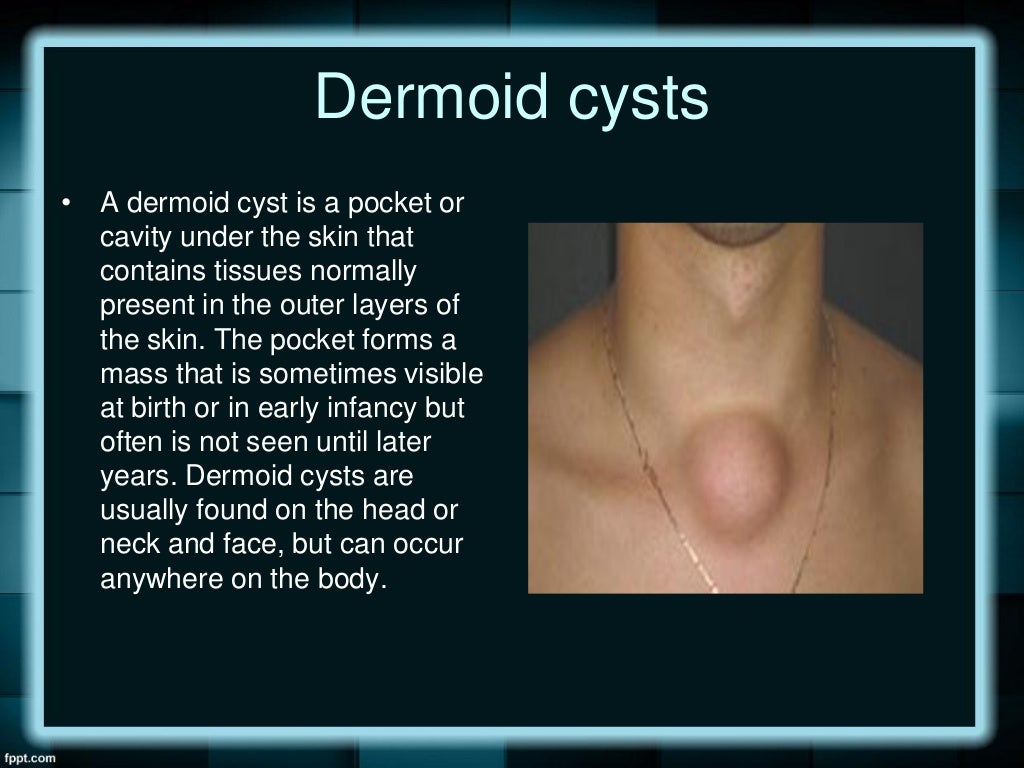 Case of the week : Thyroglossal cyst