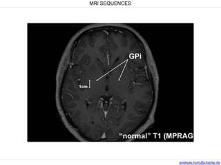 Function & Anatomy of the Basal Ganglia | PPTX