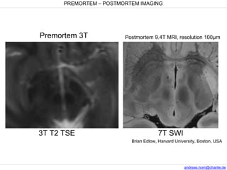 Function & Anatomy of the Basal Ganglia | PPTX