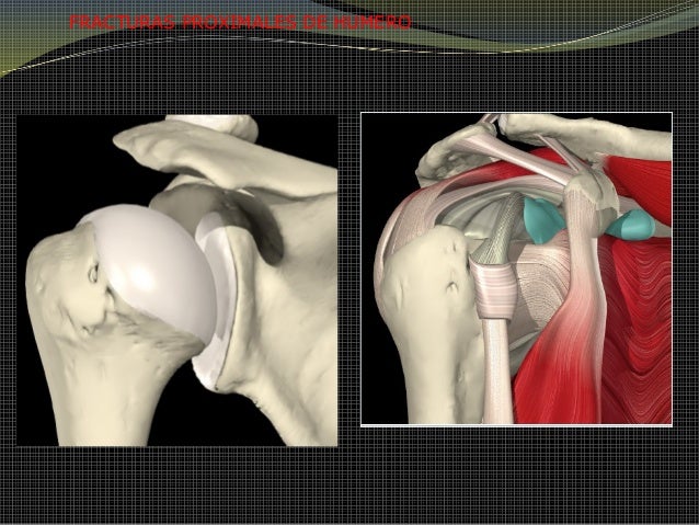 2 fx humero proximal Dr Miguel Mite