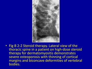 2 generalized osteoporosis | PPTX