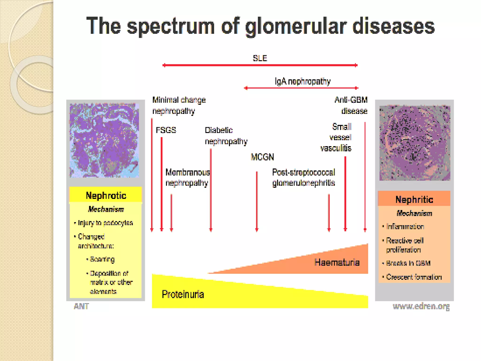 2 GLOMERULAR DISEASES.pptx
