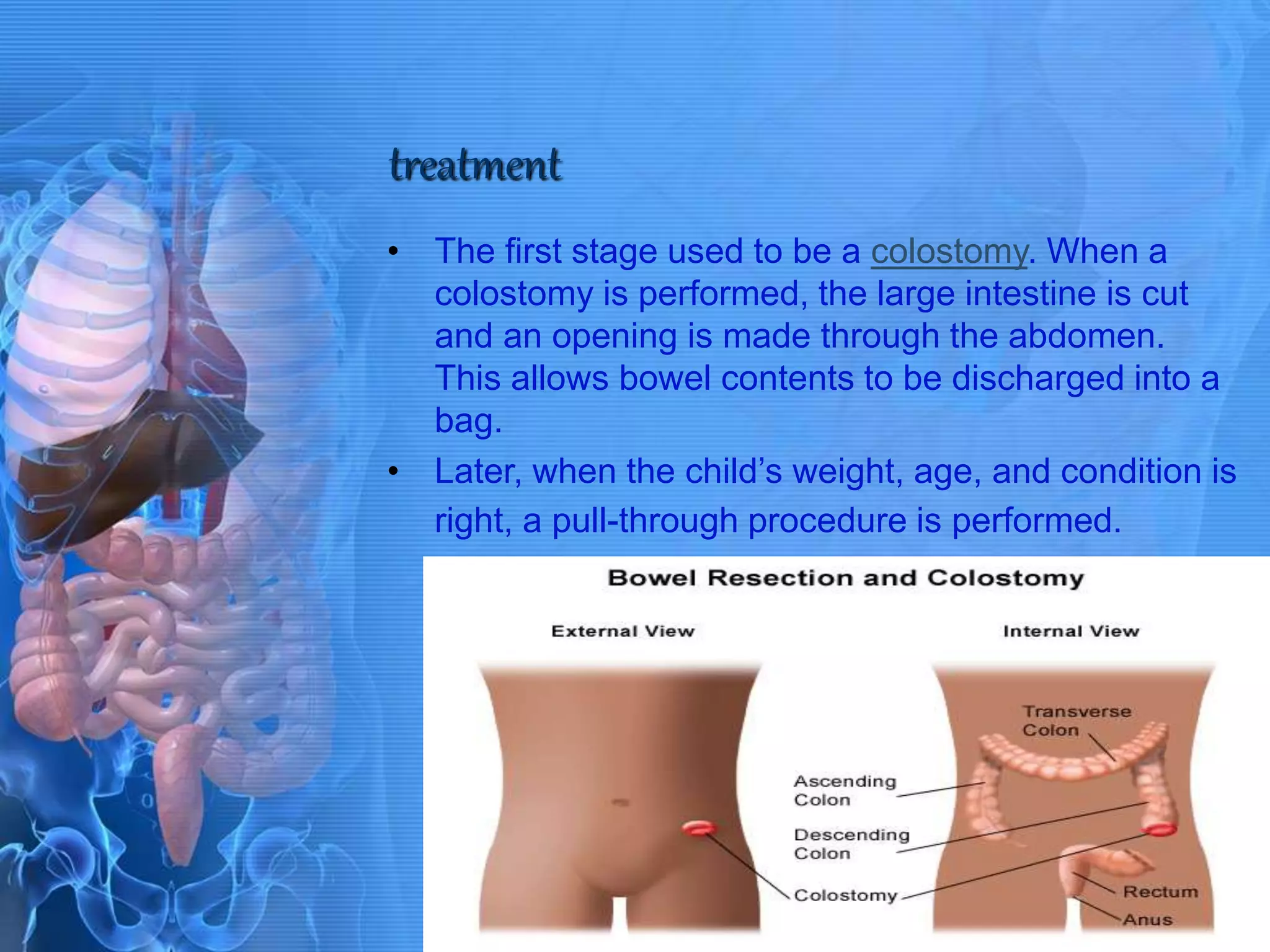 (2) hirschsprung disease | PPT