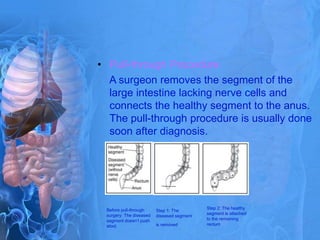 (2) hirschsprung disease | PPT