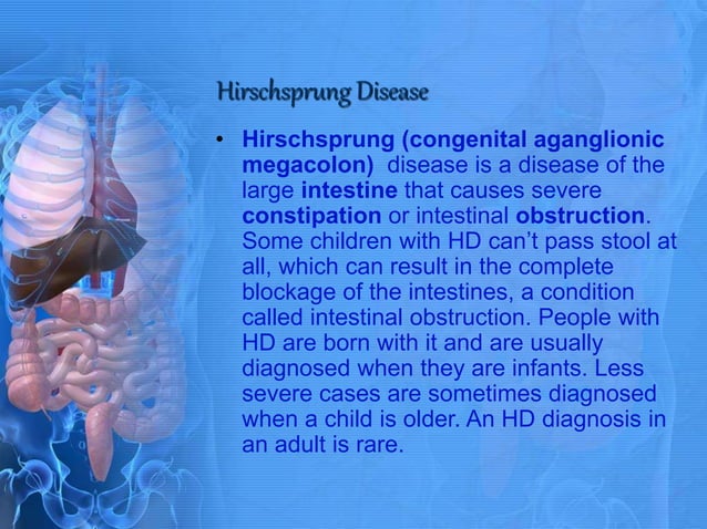 (2) hirschsprung disease | PPT