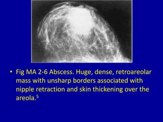 2 ill defined breast masses | PPTX | Cancer | Diseases and Conditions