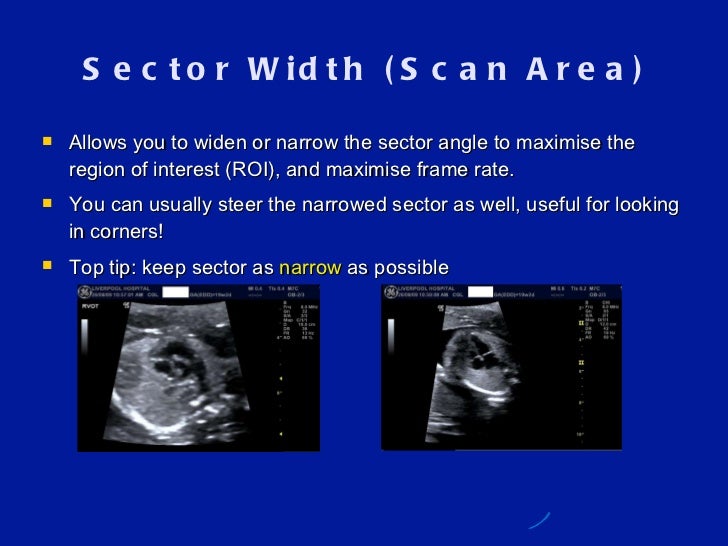 Image Optimization for Critical Care Ultrasound
