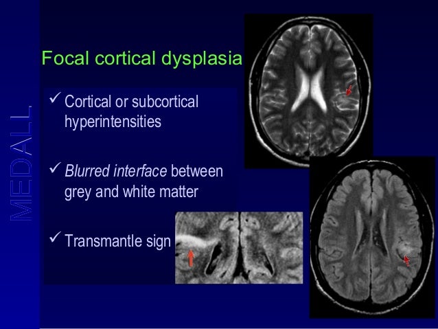 Integrated Diagnostics – A Unique Epilepsy Approach
