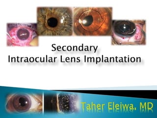 secondary IOL implantation | PPTX