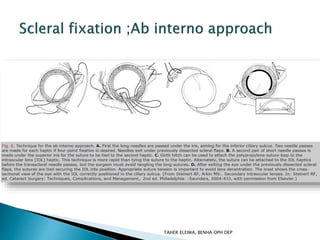 secondary IOL implantation | PPTX