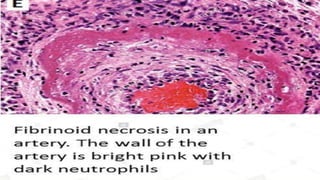 Necrosis and it's types | PPTX