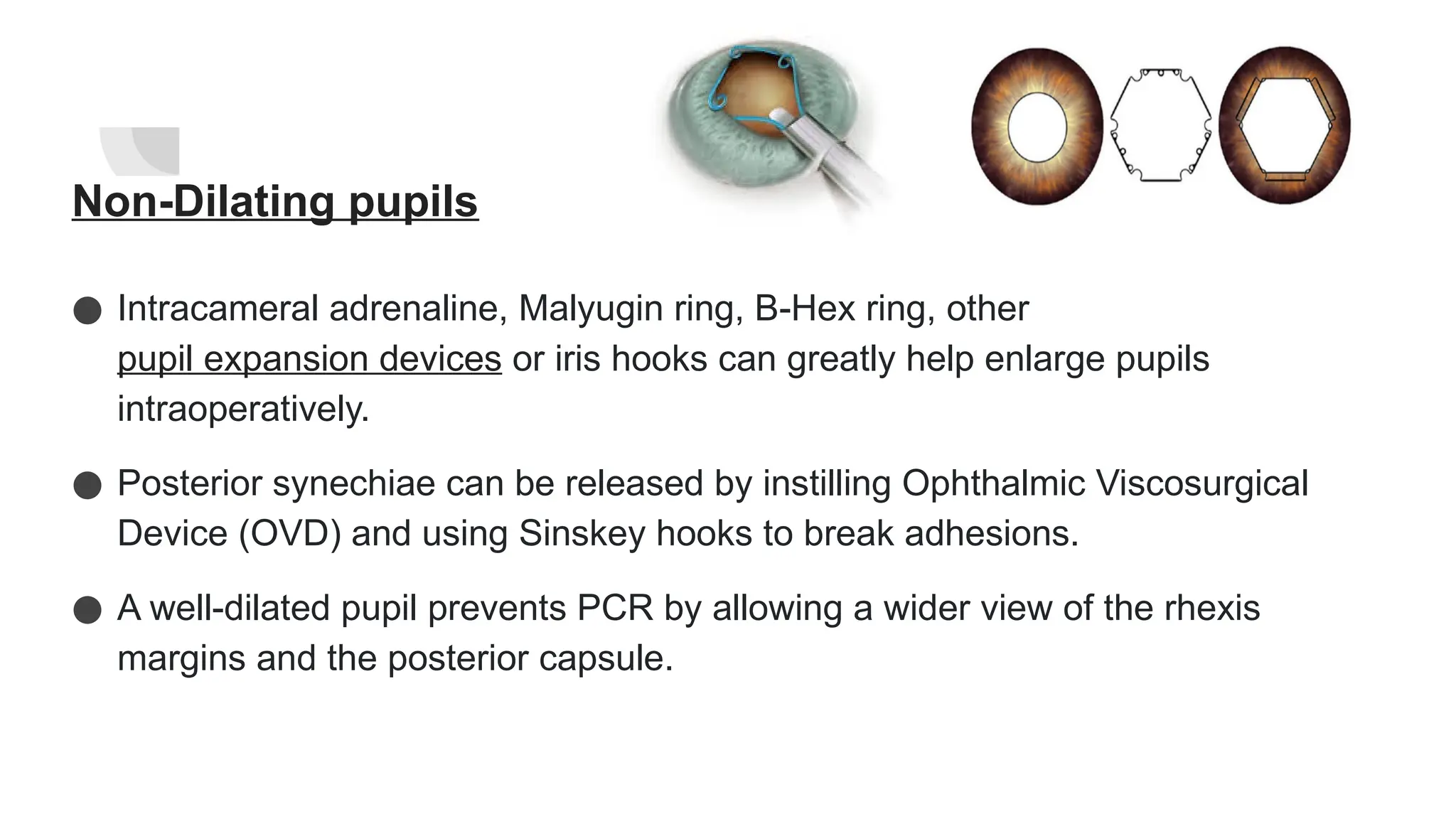 posterior capsular rent and nucleus drop | PPTX