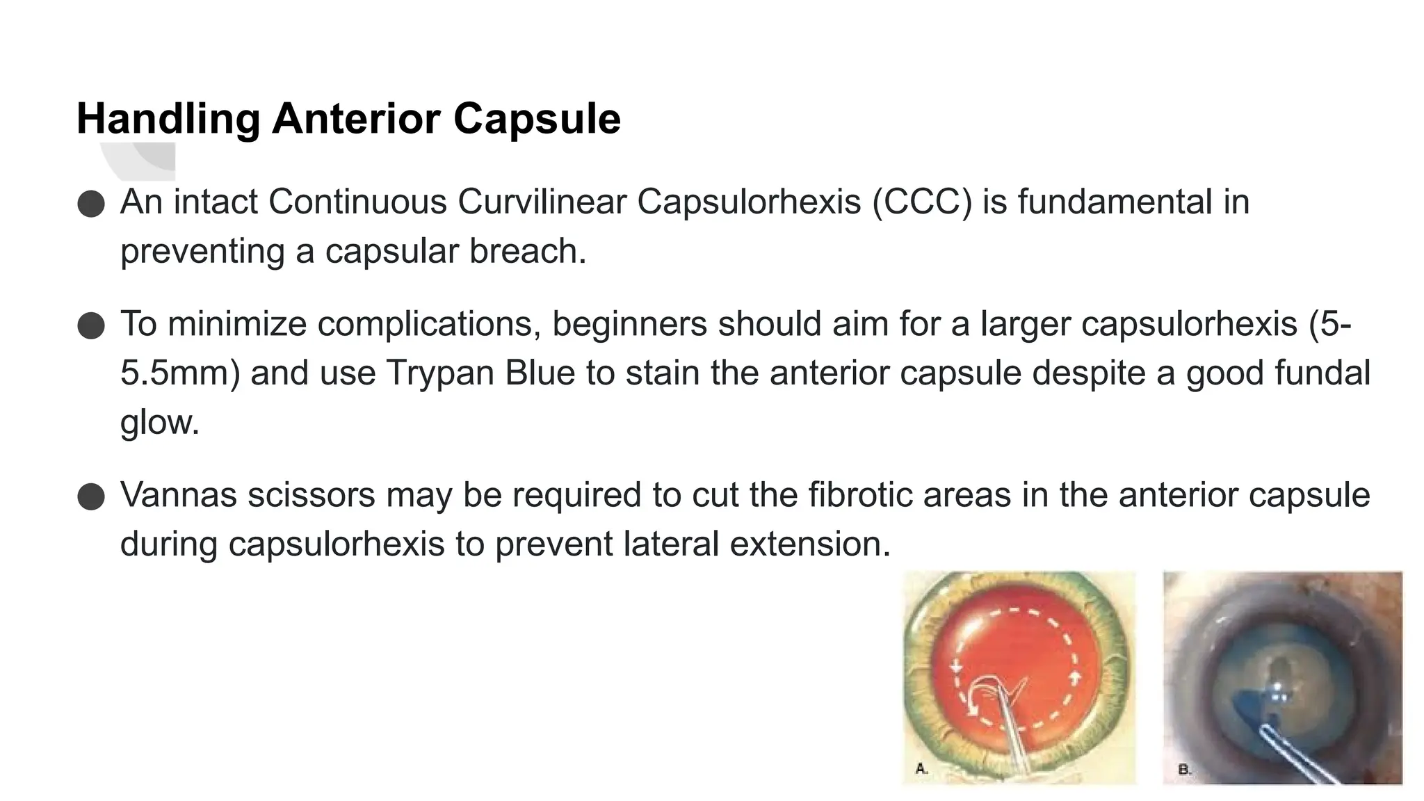 posterior capsular rent and nucleus drop | PPTX