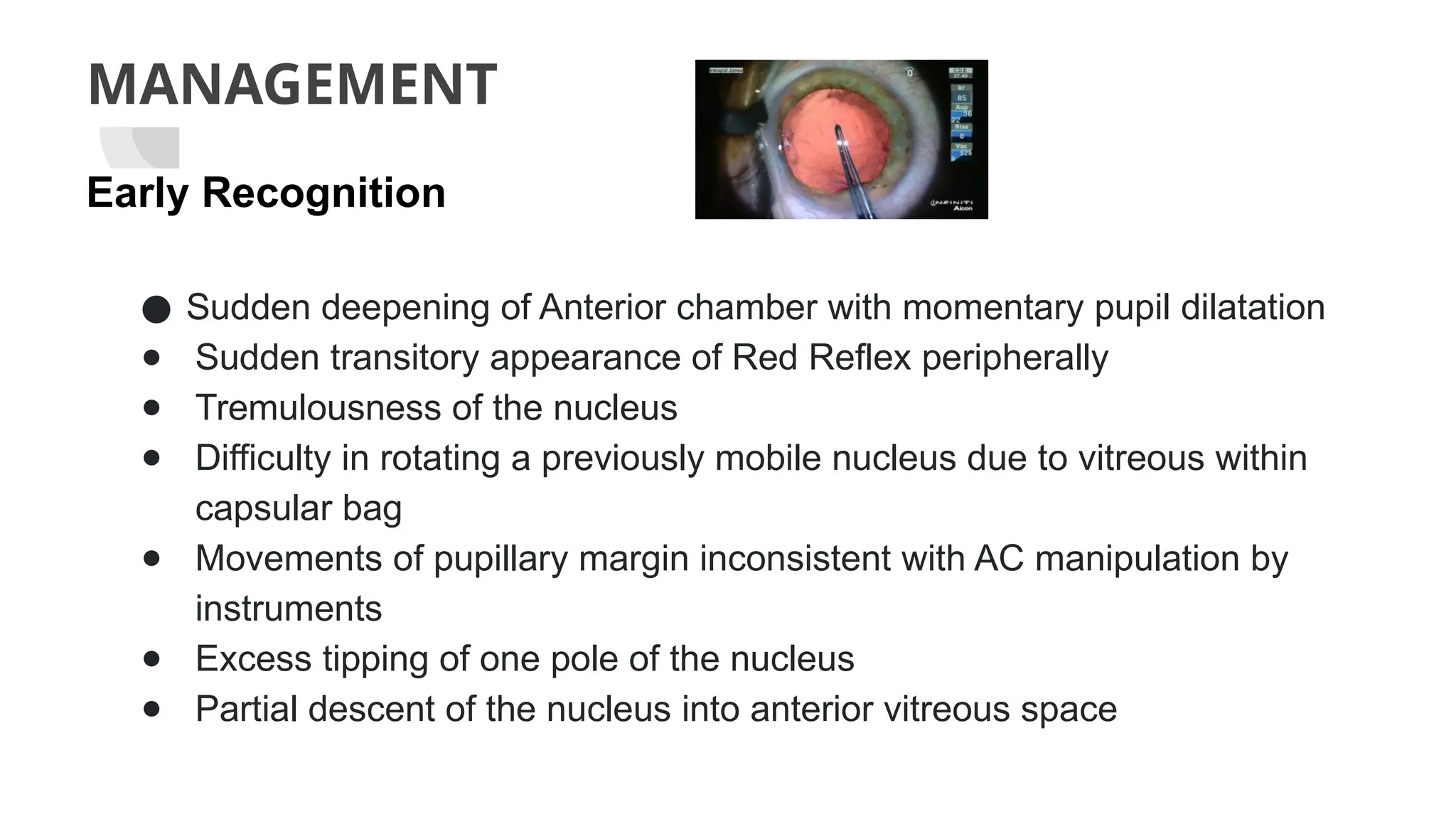 posterior capsular rent and nucleus drop | PPTX