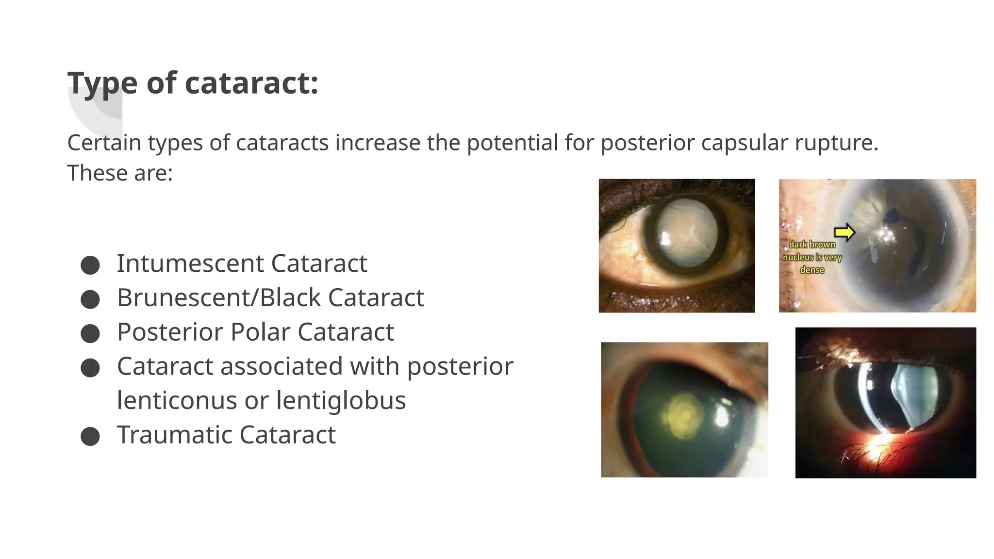 posterior capsular rent and nucleus drop | PPTX