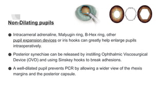 posterior capsular rent and nucleus drop | PPTX