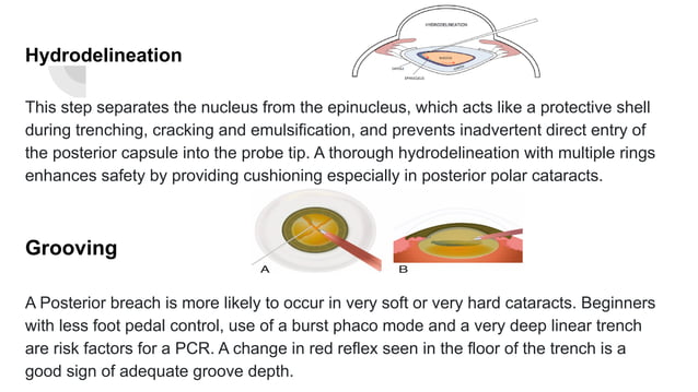 posterior capsular rent and nucleus drop | PPTX