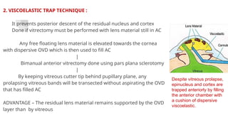 posterior capsular rent and nucleus drop | PPTX