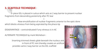 posterior capsular rent and nucleus drop | PPTX