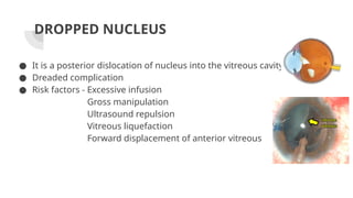 posterior capsular rent and nucleus drop | PPTX