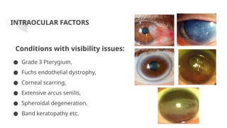 posterior capsular rent and nucleus drop | PPTX