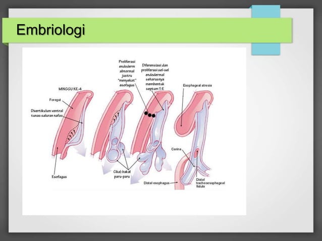2_KULIAH_Kelainan_Kongenital_Saluran_Ce.ppt