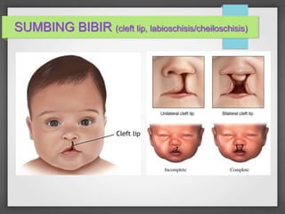 2_KULIAH_Kelainan_Kongenital_Saluran_Ce.ppt