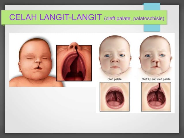 2_KULIAH_Kelainan_Kongenital_Saluran_Ce.ppt