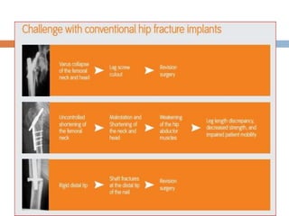 Outcome of intertrochanteric fractures treated by intramedullary nail ...