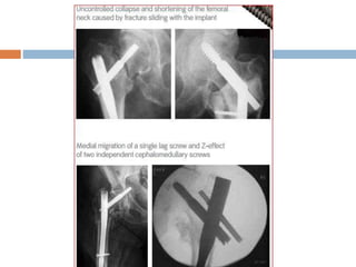 Outcome of intertrochanteric fractures treated by intramedullary nail ...