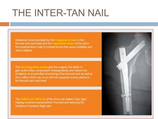 Outcome of intertrochanteric fractures treated by intramedullary nail ...