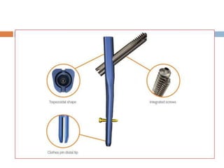 Outcome of intertrochanteric fractures treated by intramedullary nail ...