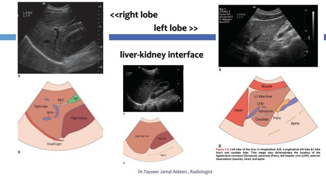liver ultrasonography | PPTX | Endocrine and Metabolic Diseases ...
