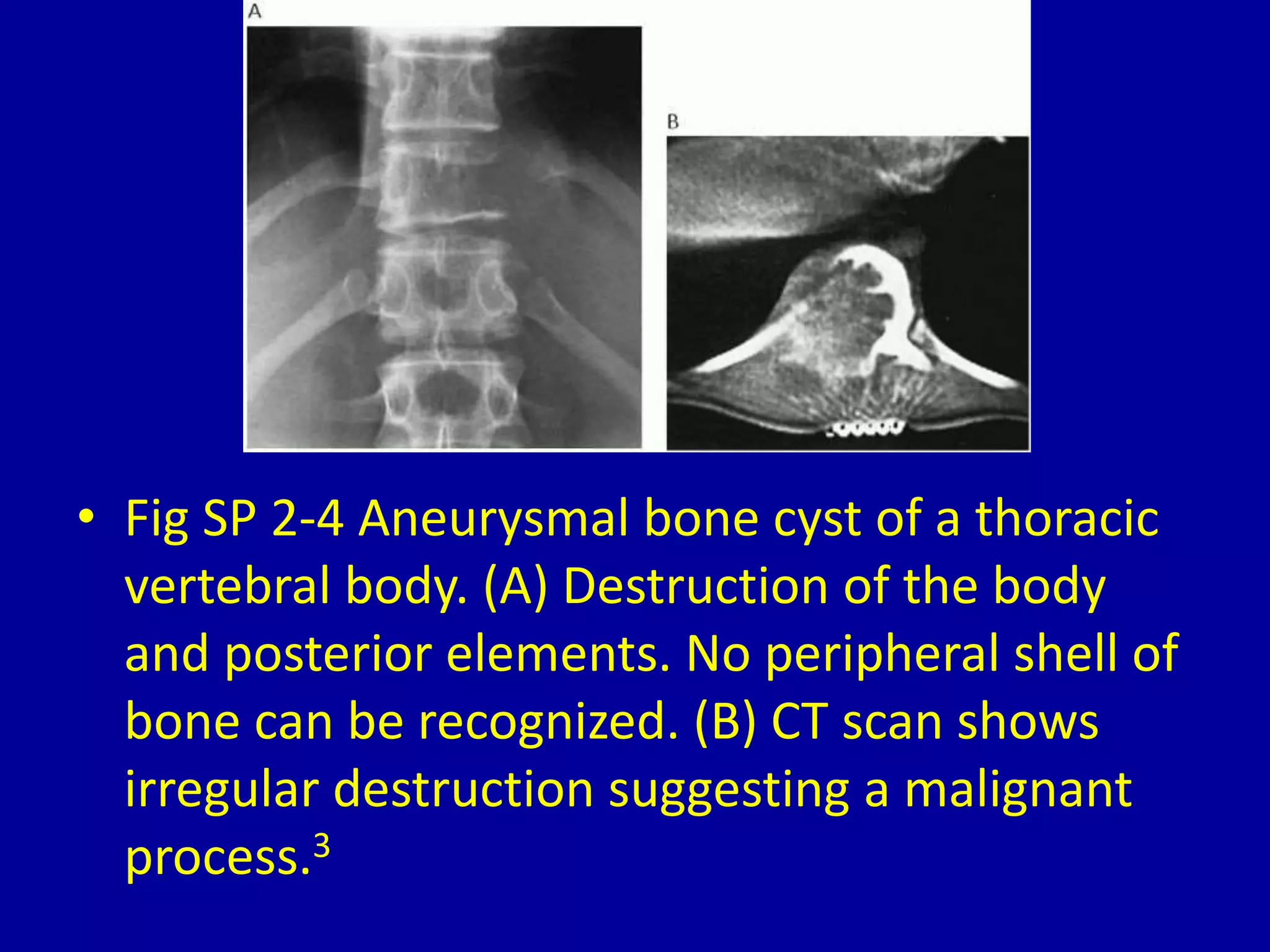 2 lytic lesion of a vertebral body or | PPTX