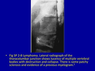 2 lytic lesion of a vertebral body or | PPTX