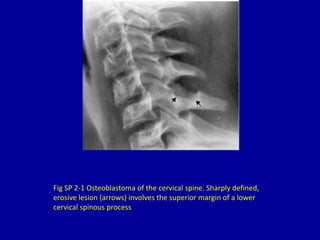 2 lytic lesion of a vertebral body or | PPTX