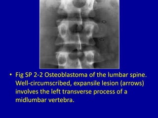 2 lytic lesion of a vertebral body or | PPTX